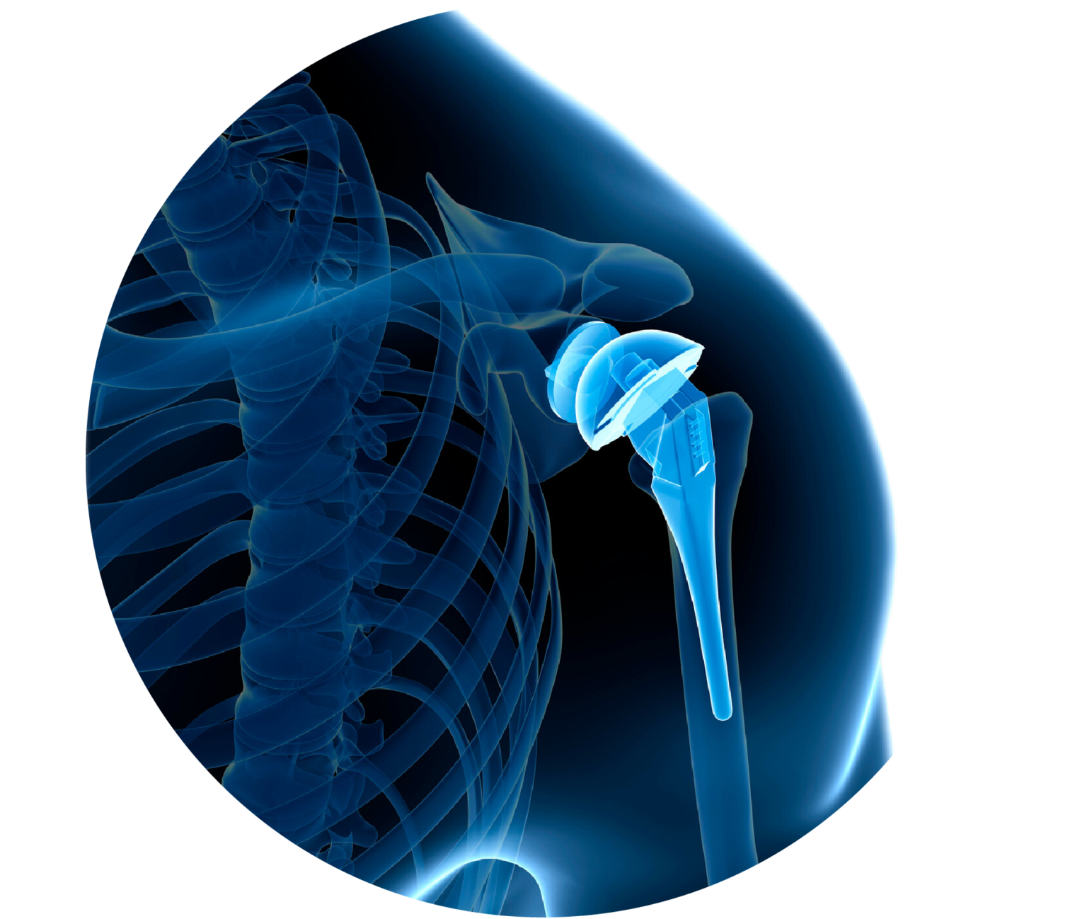 Prótesis de hombro - Instituto de Hombro