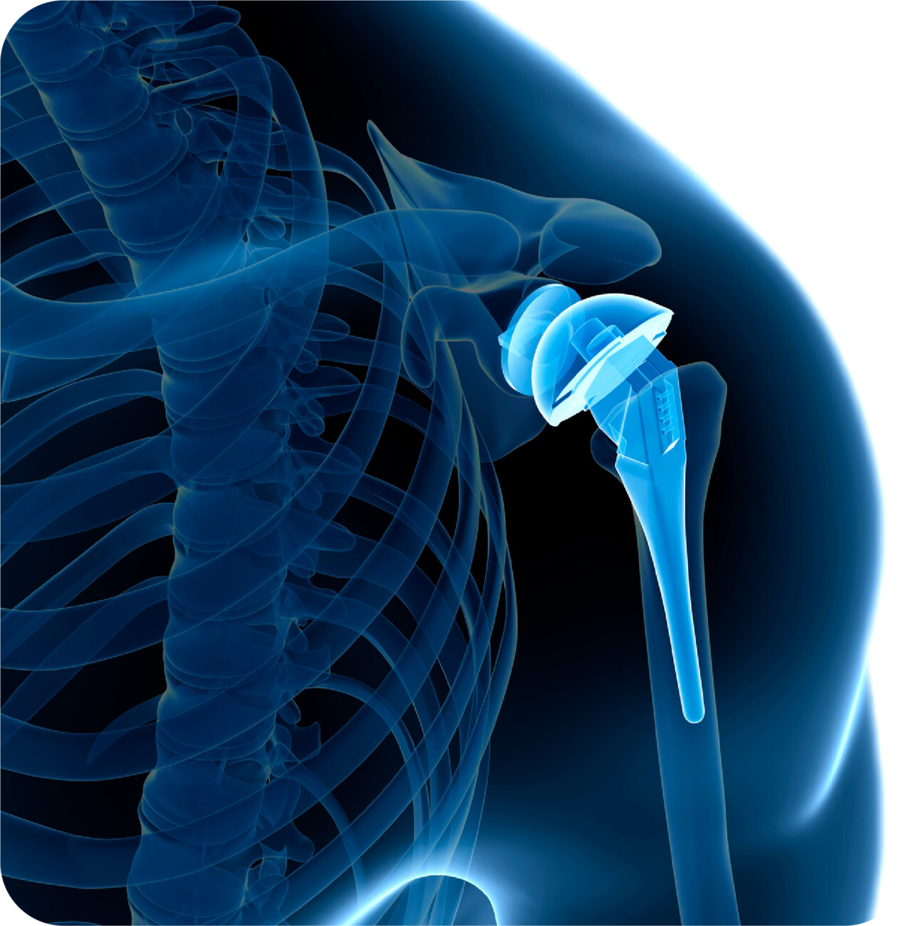 Prótesis de hombro - Instituto de Hombro